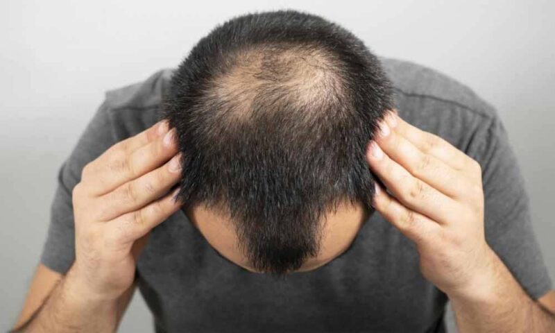 Begini Cara Mengobati Rambut Rontok pada Pria yang Diyakini Ampuh ...